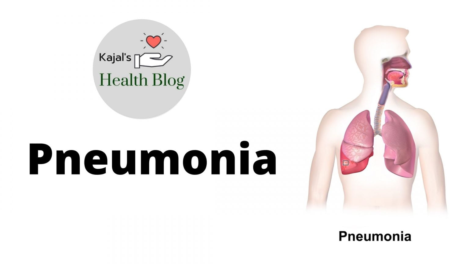 Pneumonia Classification, Causes, Pathophysiology, Management and ...